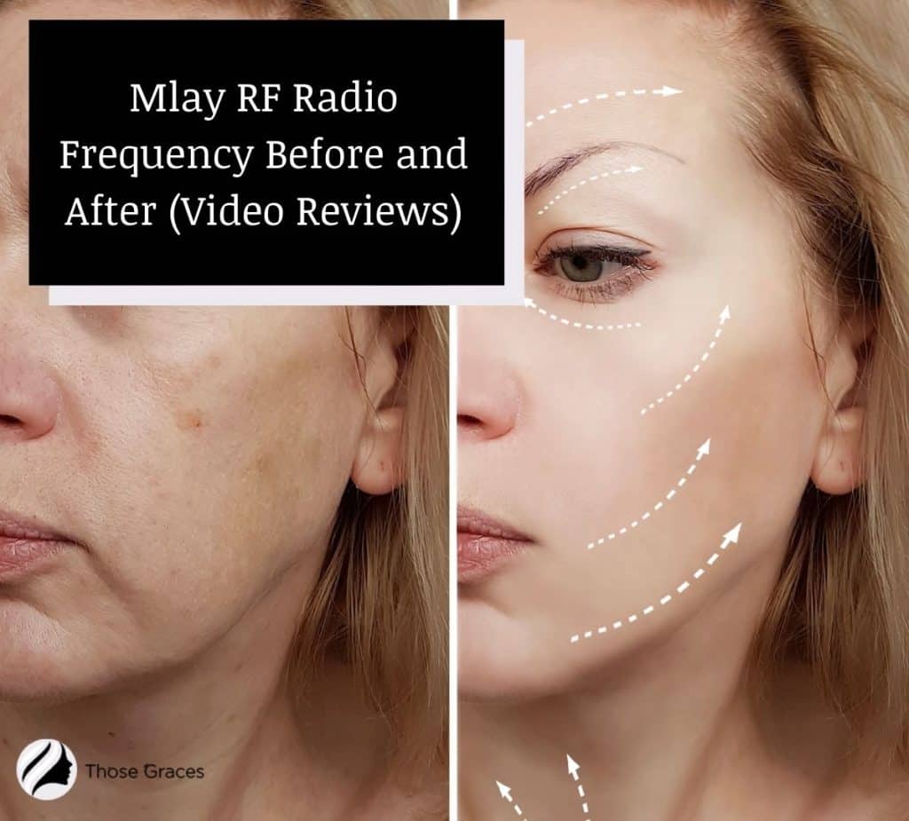 Mlay RF Radio Frequency Before and After Treatment (Videos ... Mlay RF Radio Frequency Before and After Treatment (Videos ...